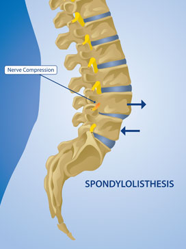 Spondylolisthesis Symptoms And Treatment Options | Spine Health